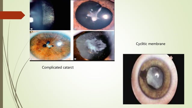 Anterior uveitis - SIGNS, SYMPTOMS AND TREATMENT | PPTX | Eye and ...