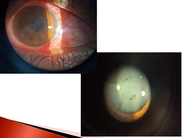 RE Anterior uveitis case presentation | PPTX