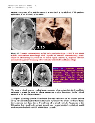 Topic of the month: Radiological pathology of intracranial aneurysms | PDF