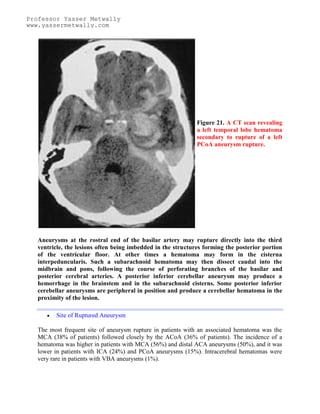 Topic of the month: Radiological pathology of intracranial aneurysms | PDF