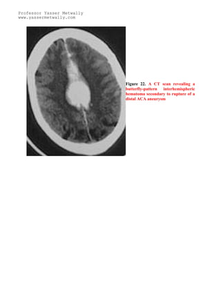 Topic of the month: Radiological pathology of intracranial aneurysms | PDF