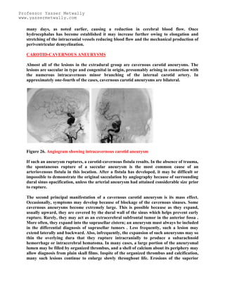 Topic of the month: Radiological pathology of intracranial aneurysms | PDF