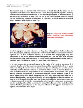 Topic of the month: Radiological pathology of intracranial aneurysms | PDF