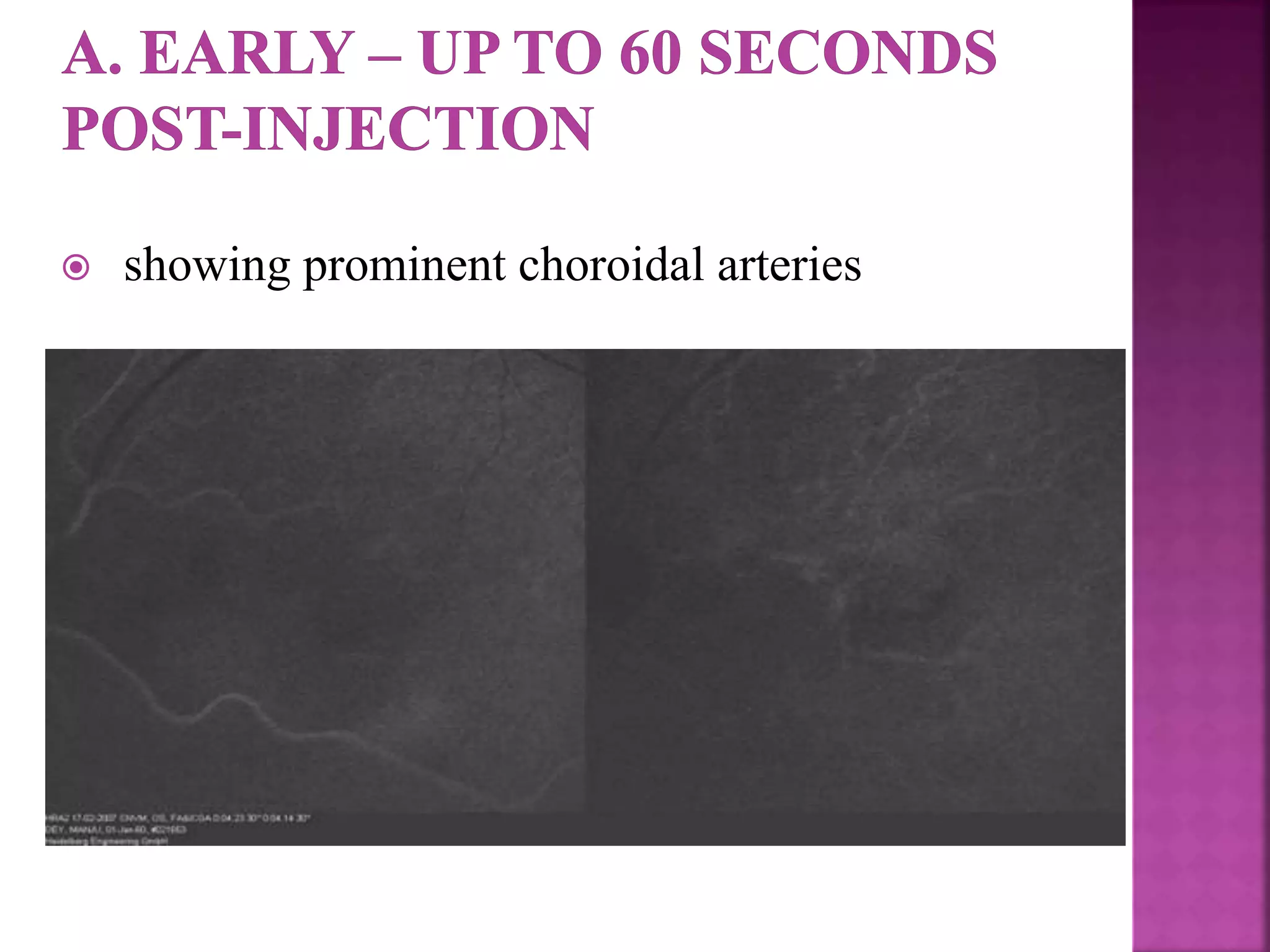 Indocyanine Green Angiography (ICG) | PPTX