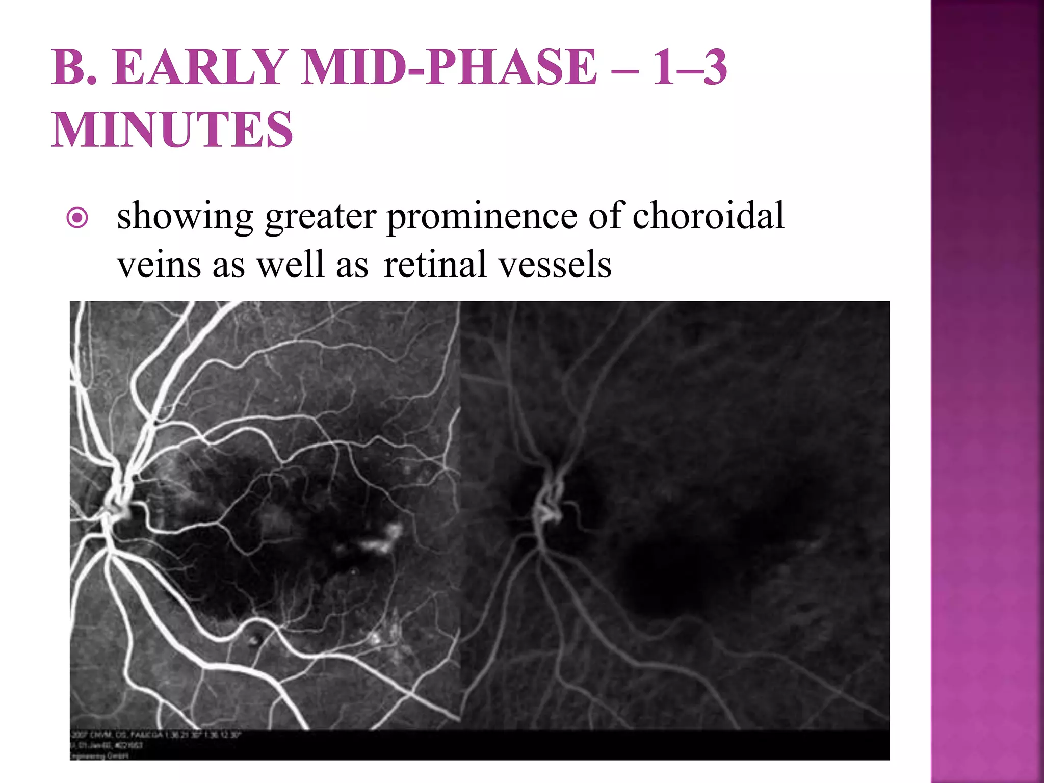 Indocyanine Green Angiography (ICG) | PPTX