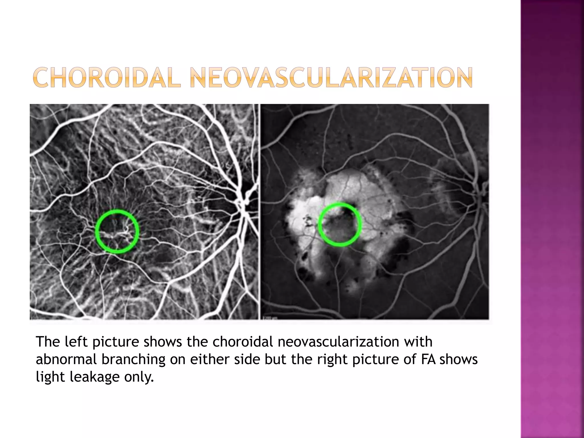 Indocyanine Green Angiography (ICG) | PPTX