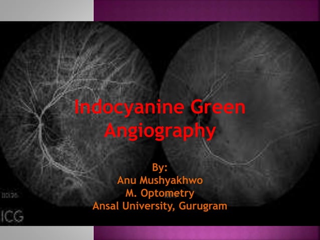 Indocyanine Green Angiography (ICG) | PPTX | Eye and Vision Conditions ...