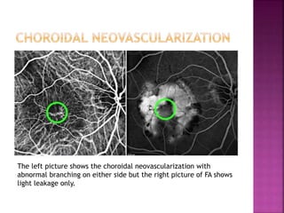 Indocyanine Green Angiography (ICG) | PPTX