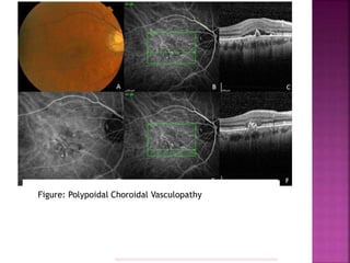 Indocyanine Green Angiography (ICG) | PPTX