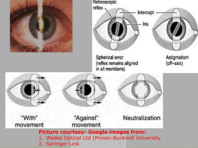 Objective Refraction and Subjective Refraction | PPTX | Eye and Vision ...