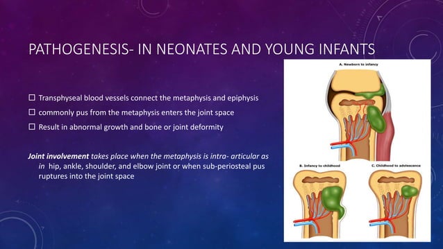 Hematogenous Osteomyelitis | PPTX | Bone and Joint Conditions ...