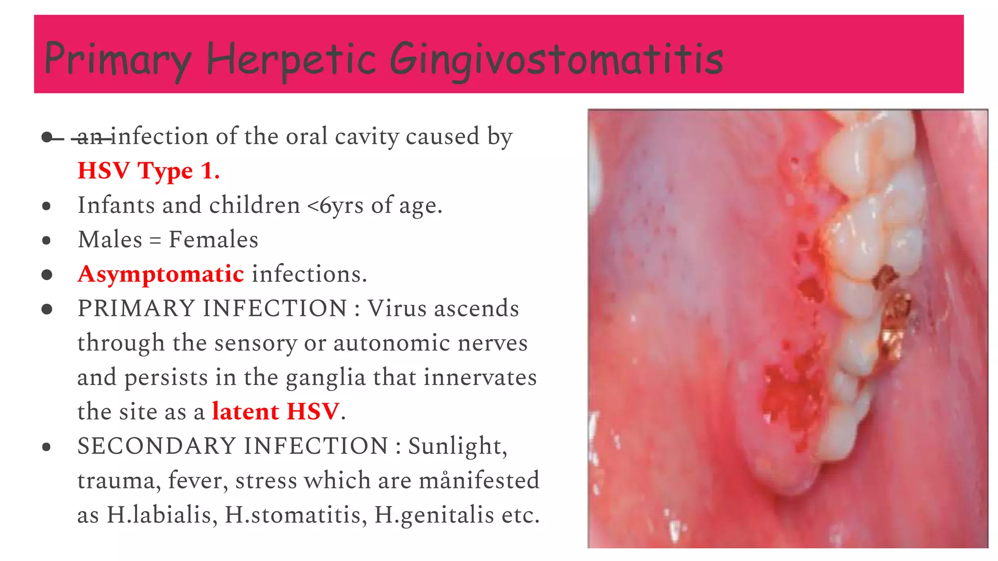 Acute gingival infections PERIO ppt | PPTX