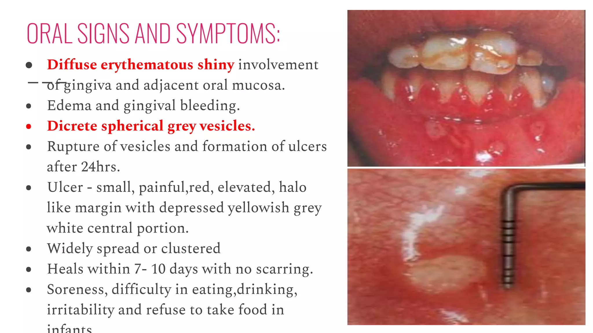 Acute gingival infections PERIO ppt | PPTX
