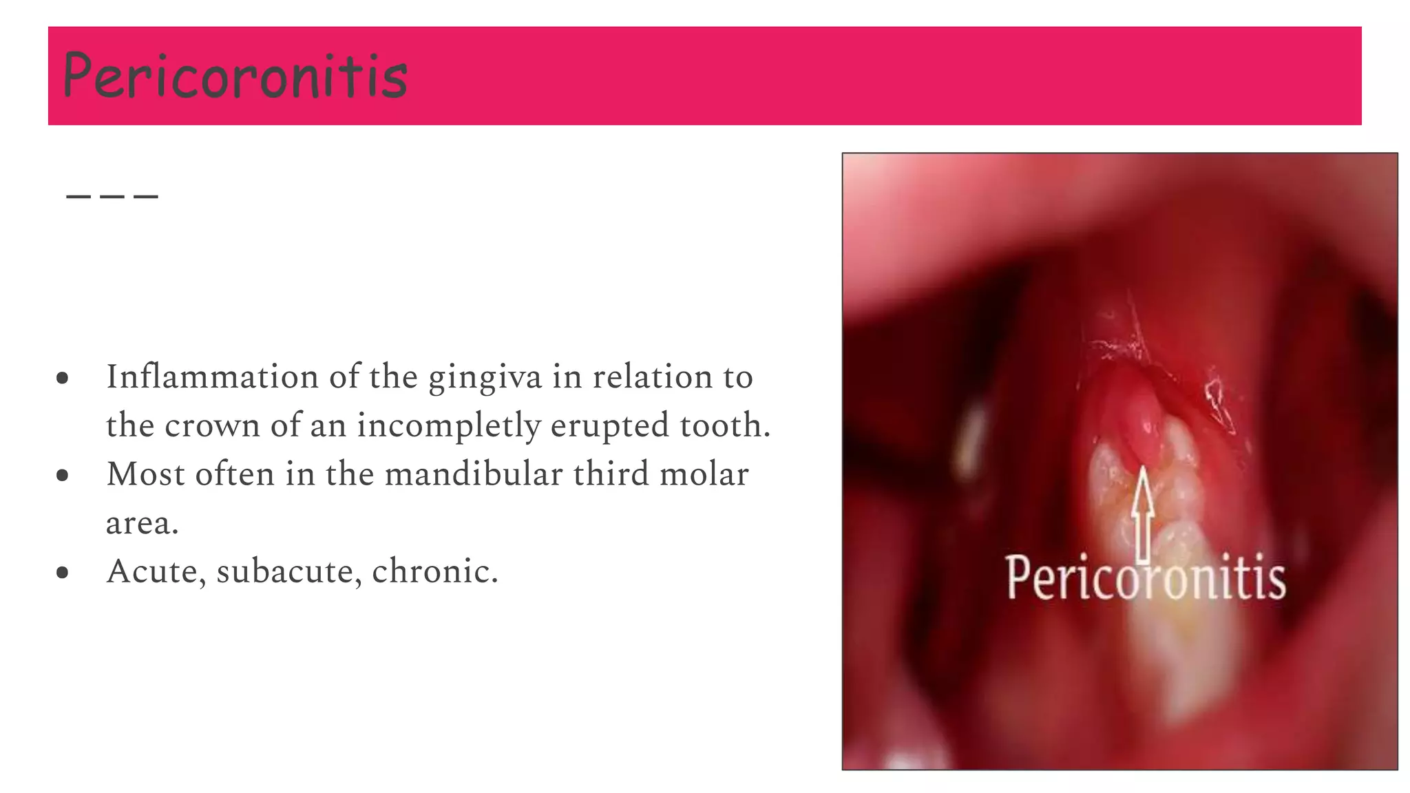 Acute gingival infections PERIO ppt | PPTX | Dental Health | Diseases and Conditions