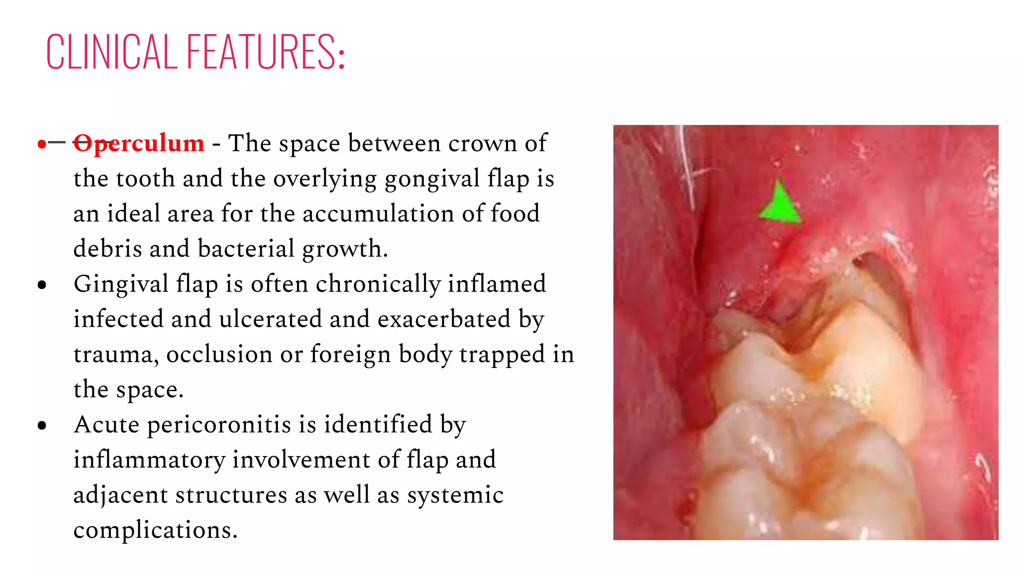 Acute gingival infections PERIO ppt | PPTX
