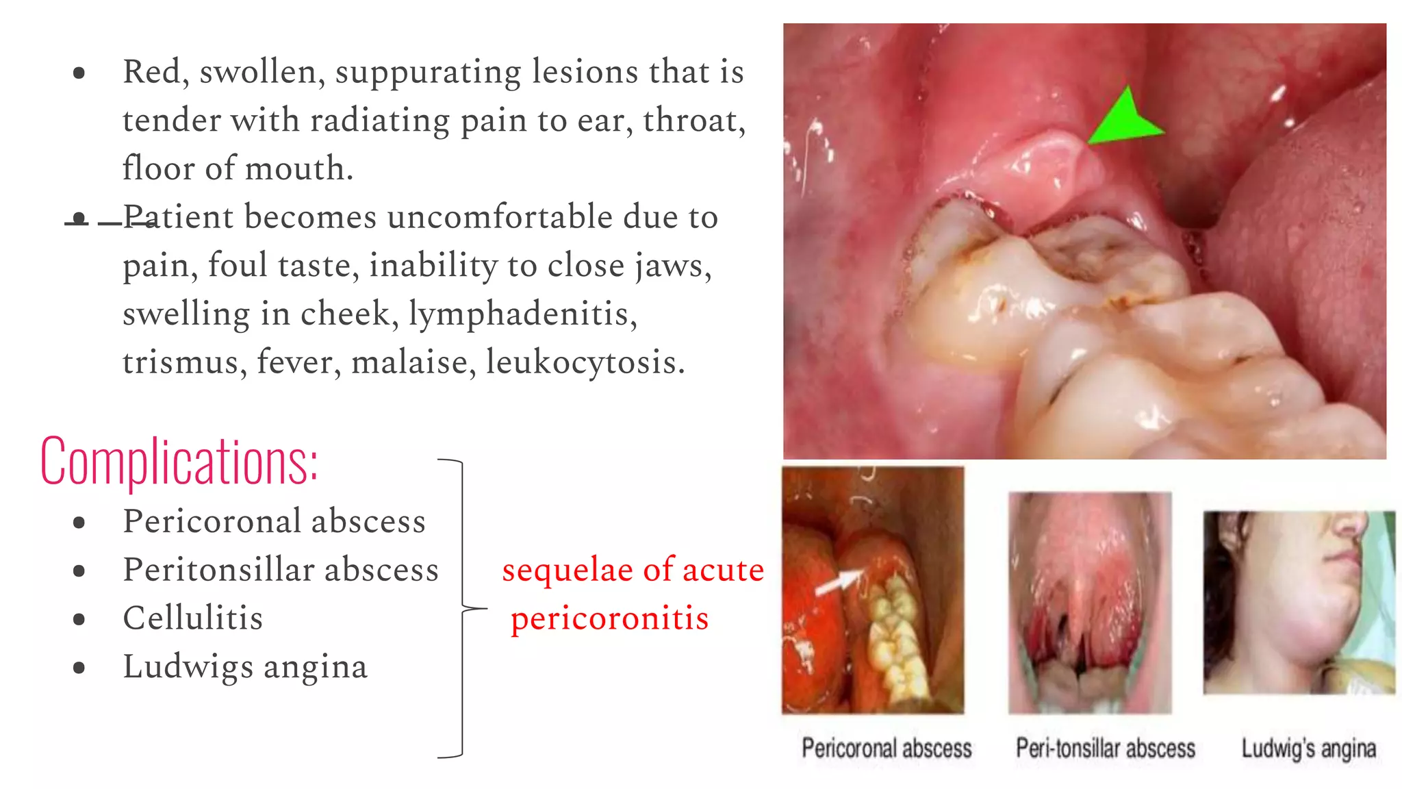 Acute gingival infections PERIO ppt | PPTX | Dental Health | Diseases and Conditions