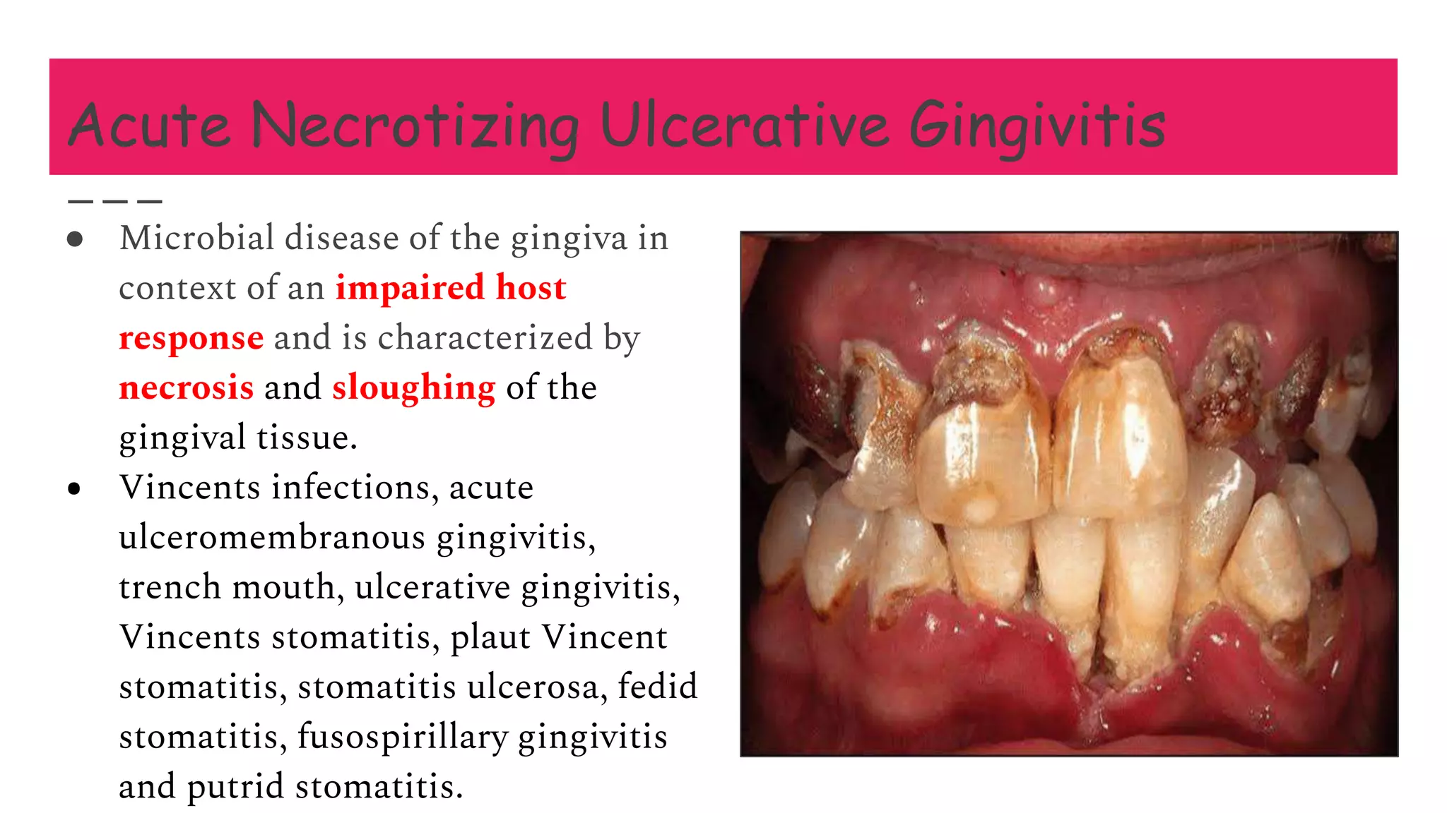 Acute gingival infections PERIO ppt | PPTX