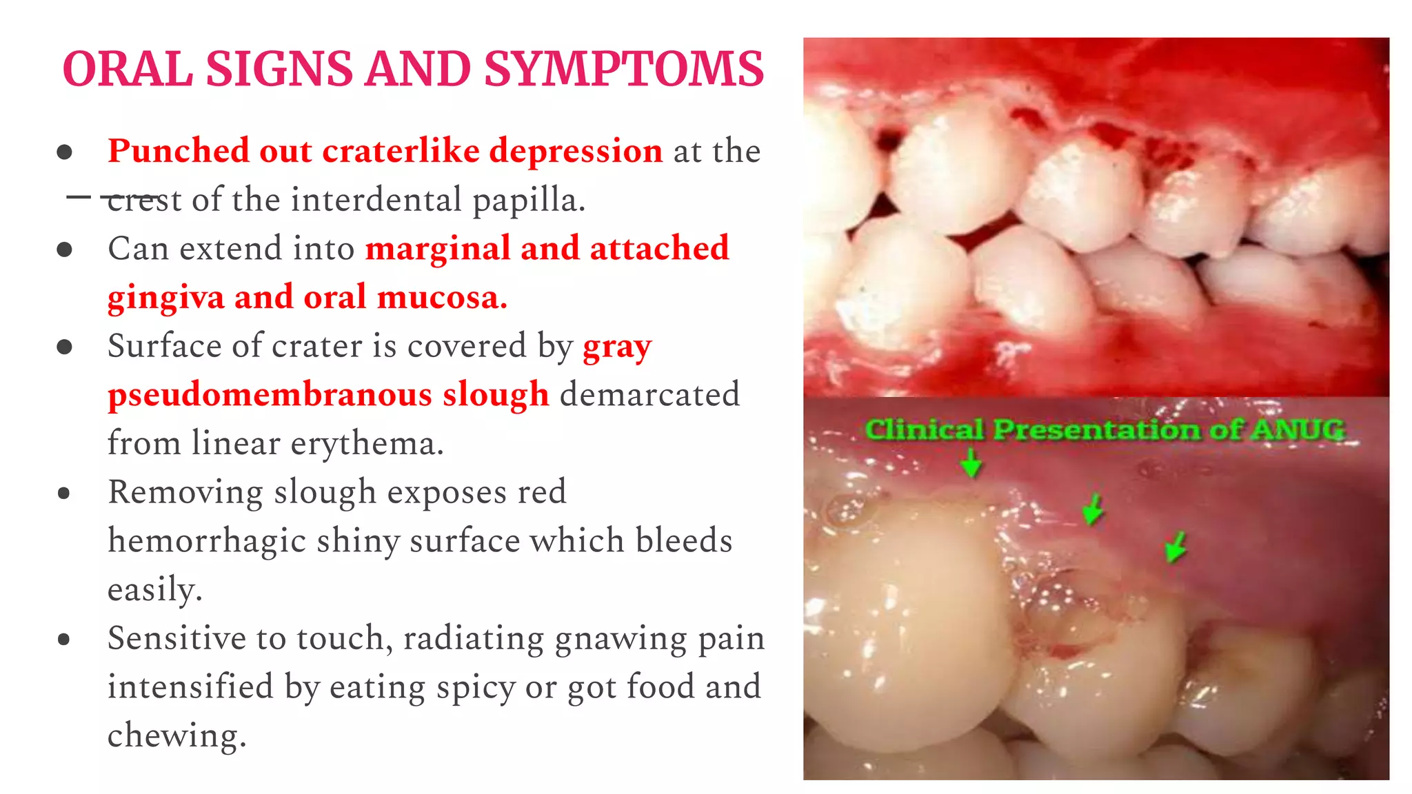 Acute gingival infections PERIO ppt | PPTX