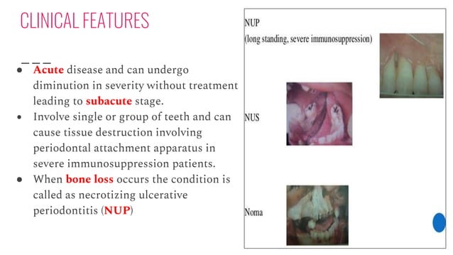 Acute gingival infections PERIO ppt | PPTX | Dental Health | Diseases ...