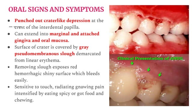 Acute gingival infections PERIO ppt | PPTX | Dental Health | Diseases ...