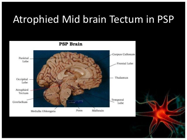 A Case of Progressive Supranuclear Palsy