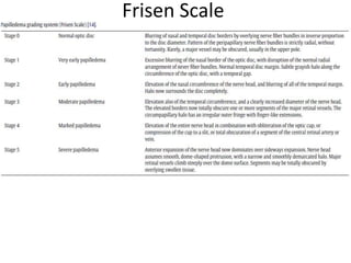 An update on the management of pseudotumor cerebri | PPTX
