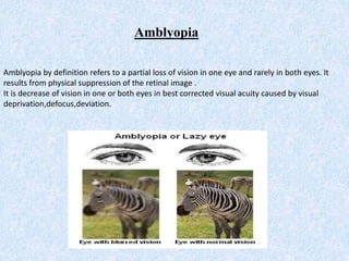 Amblyopia | PPTX