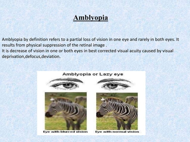Amblyopia | PPTX