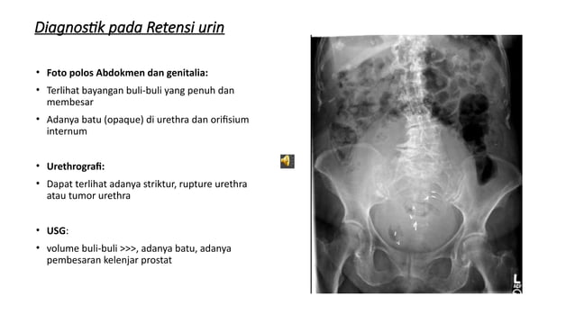 anuria, retensi urin, hematuria, prostate | PPTX