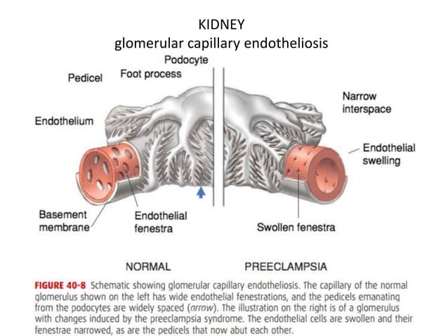 Pregnancy Induced Hypertension- Pathophysiology | PPT