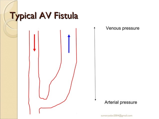 Aneurysm and av fistula