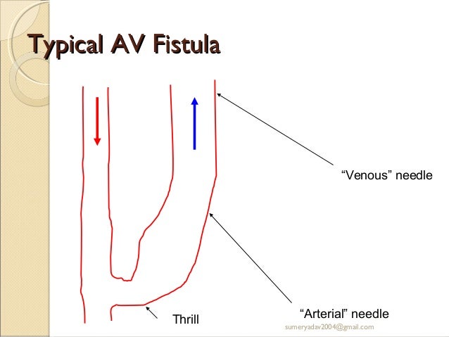 Aneurysm and av fistula