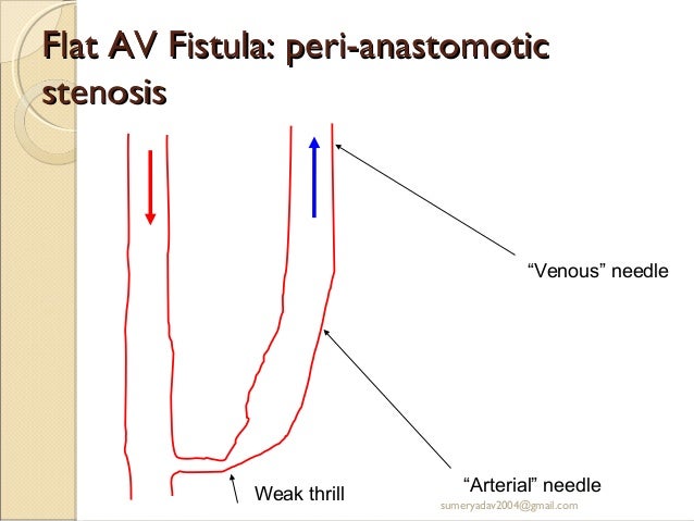 Aneurysm and av fistula