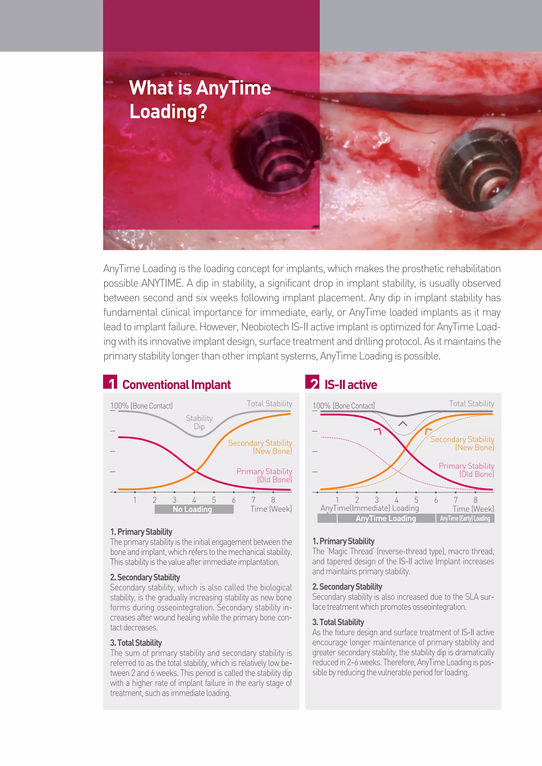 Neo Biotech IS-II Active Implant - Catalog | PDF
