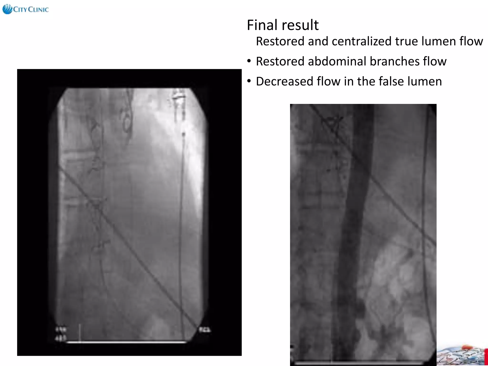Centralization of flow in aortic dissection | PPT