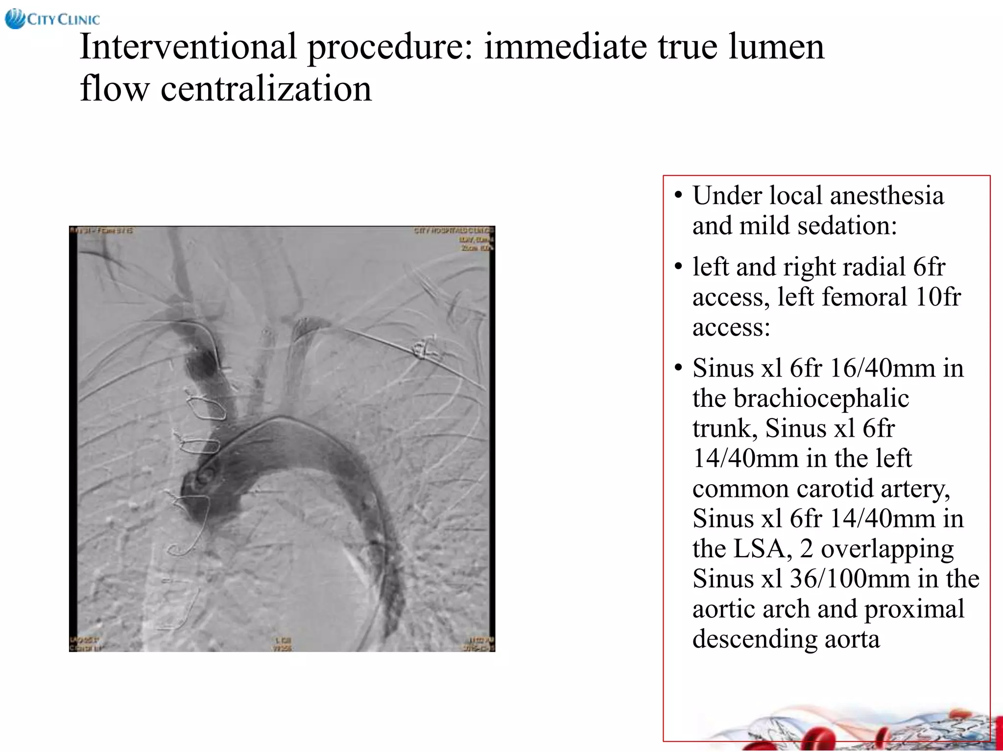 Centralization of flow in aortic dissection | PPT