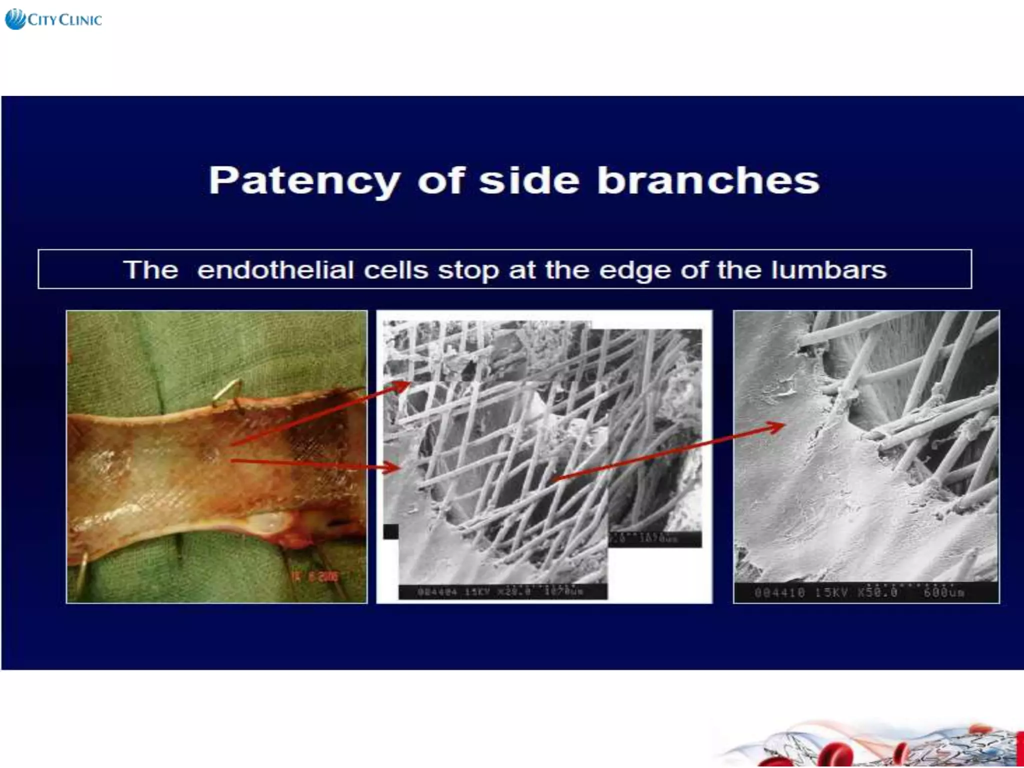 Centralization of flow in aortic dissection | PPT