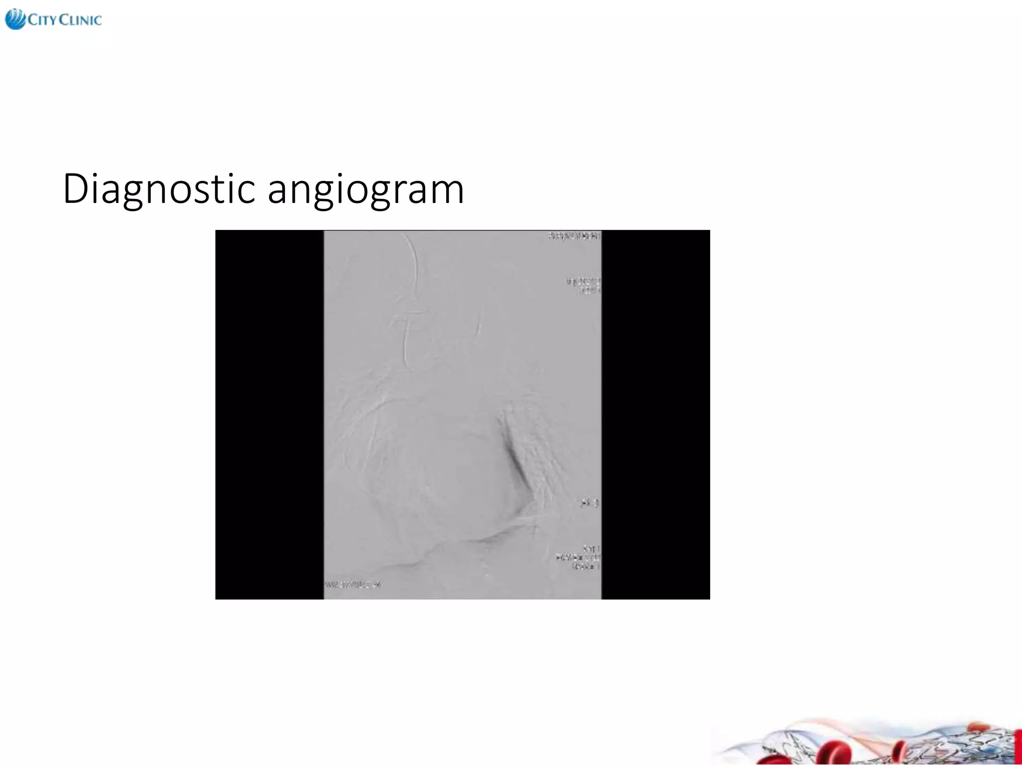 Centralization of flow in aortic dissection | PPT