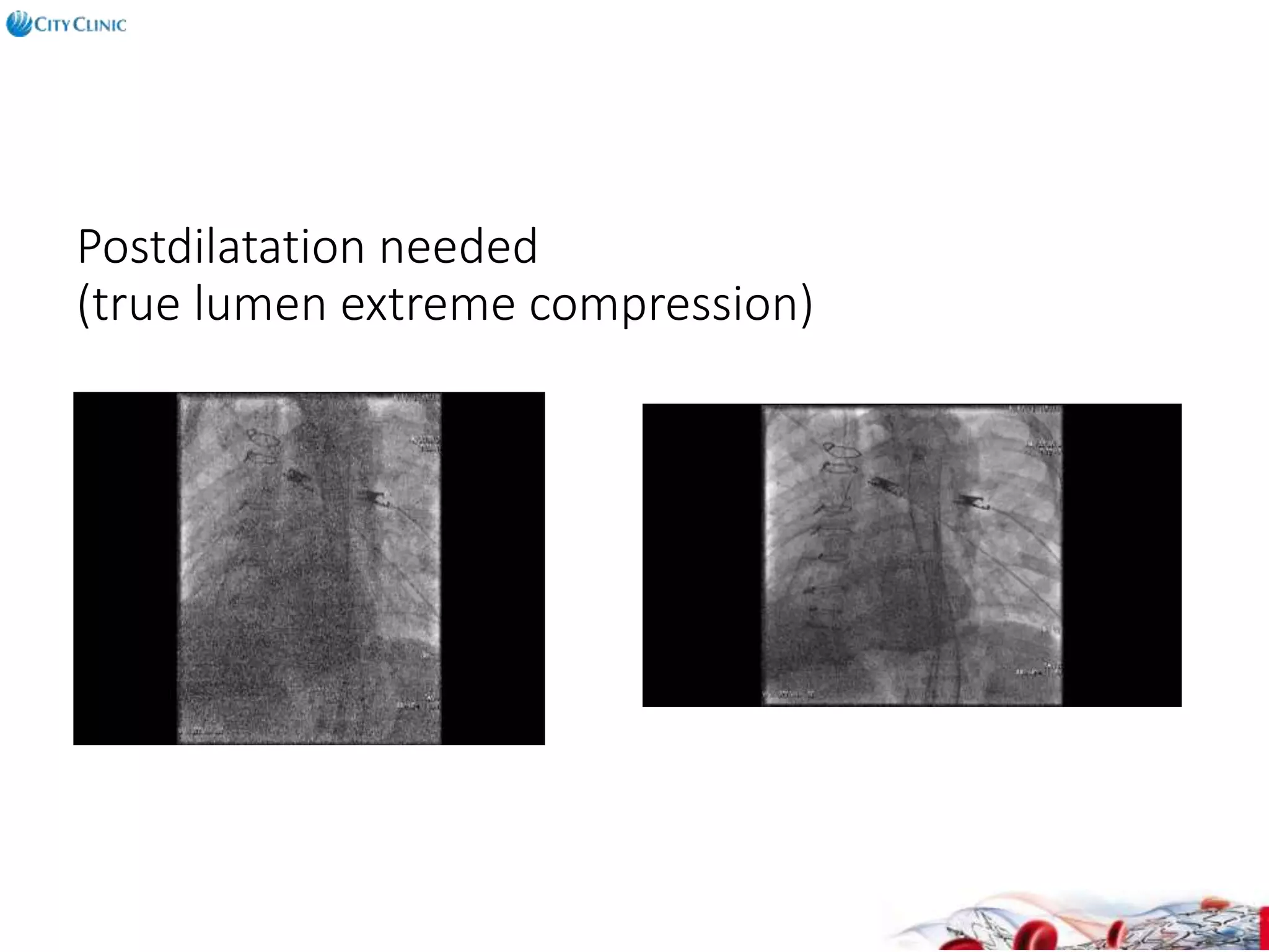 Centralization of flow in aortic dissection | PPT