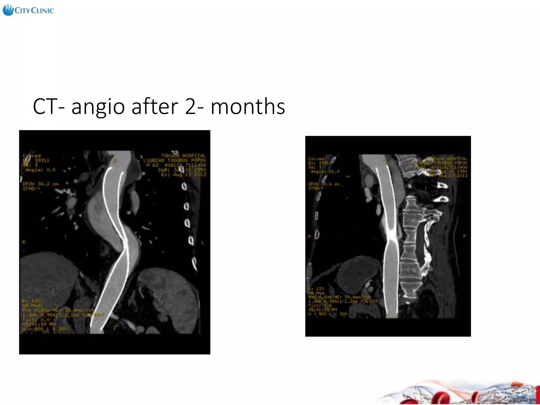 Centralization of flow in aortic dissection | PPT