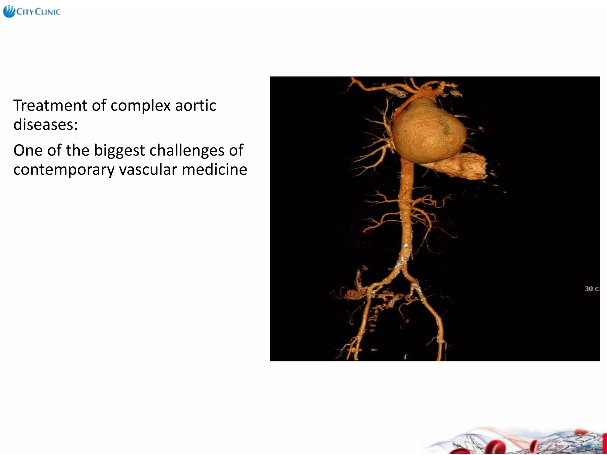 Centralization of flow in aortic dissection | PPT