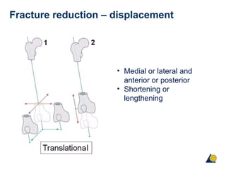 AO-Principles of fracture fixation .pptx