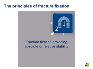 AO-Principles of fracture fixation .pptx