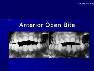 Anterior Open Bite | PPT