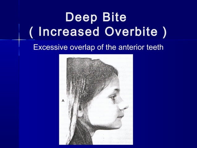 Anterior Open Bite | PPT | Dental Health | Diseases and Conditions