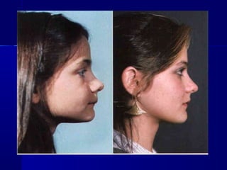 Anterior Open Bite | PPT