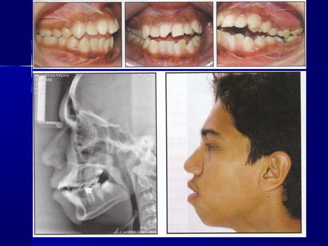 Anterior Open Bite | PPT | Dental Health | Diseases and Conditions