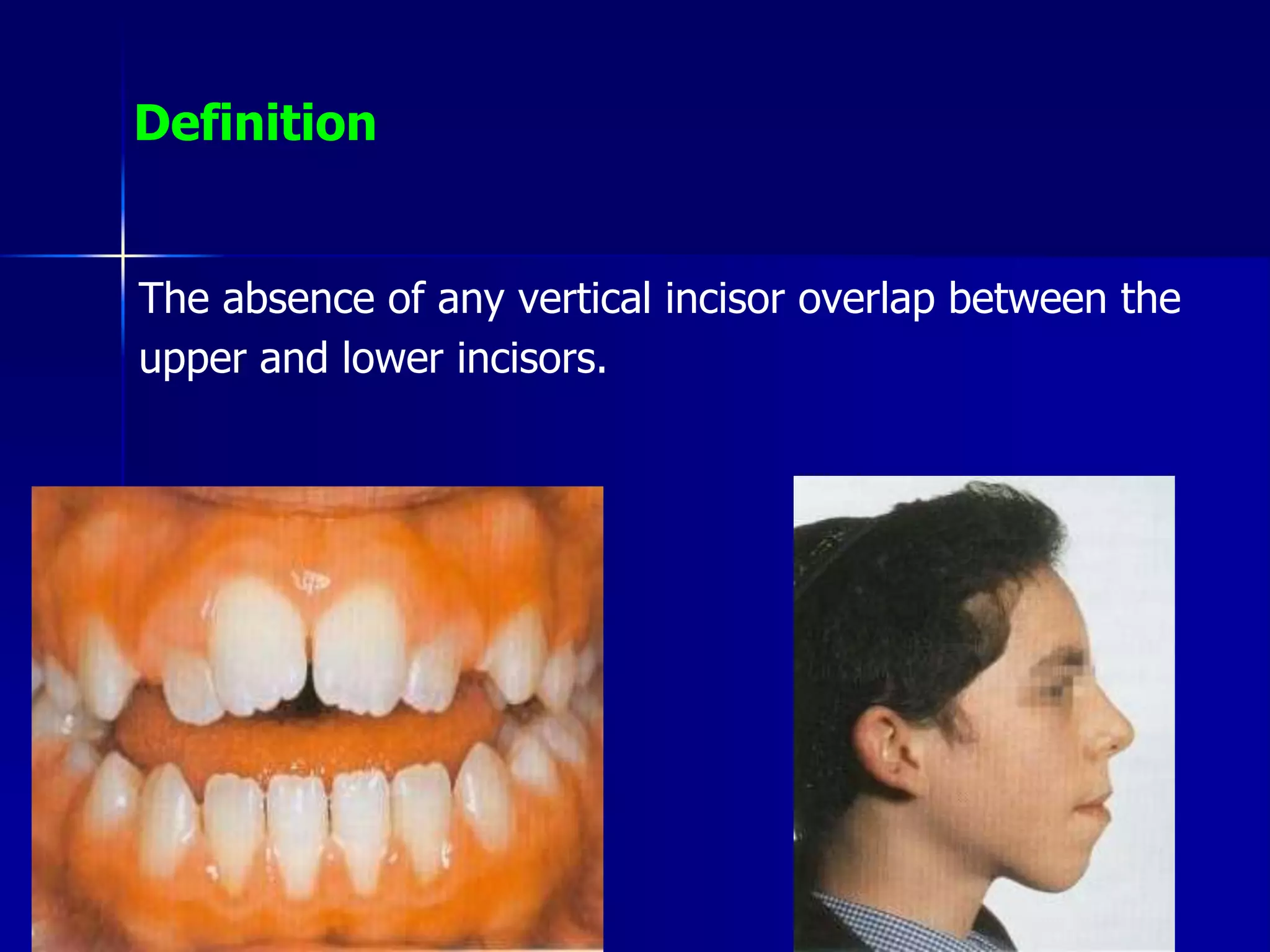 Anterior Open Bite and Deep Bite | PPTX