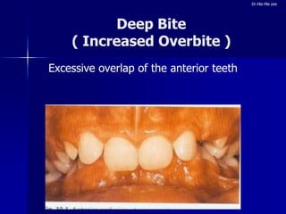 Anterior Open Bite and Deep Bite | PPTX