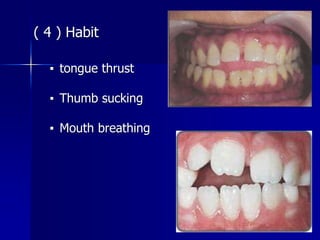 Anterior Open Bite and Deep Bite | PPTX